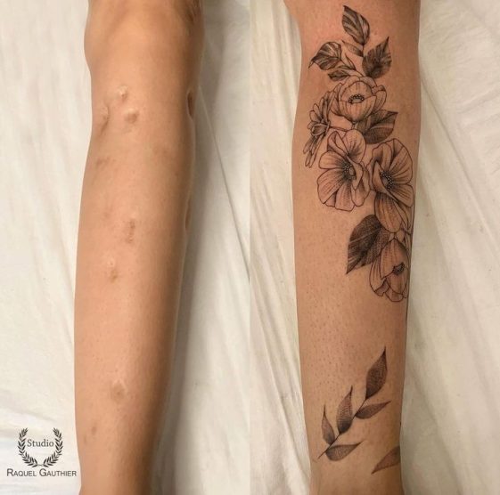 16 Iconic Transformations Of Scars Into Beautiful Tattoos