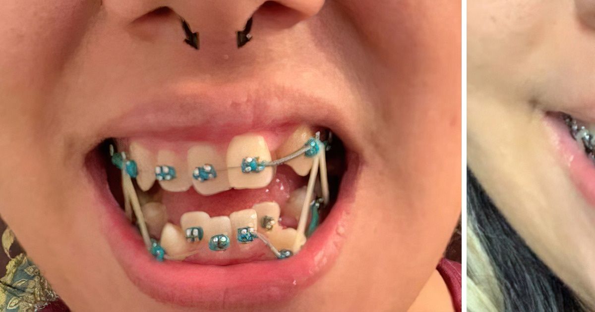 Viral Strange - 16 Insanely Teeth Transformations Into Perfect Smiles