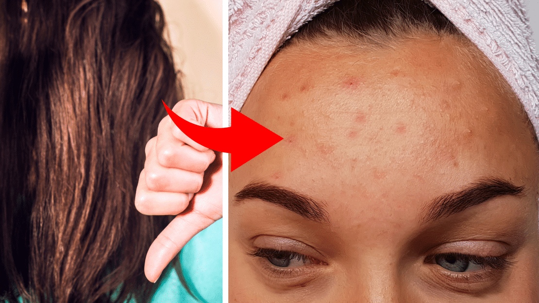 8 Body Parts Acnes Can Appear And What Triggers Them