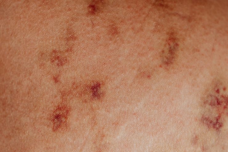 Viral Strange - Blood Clot Warning Signs