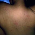 Red Spots on Skin: 13 Common Causes