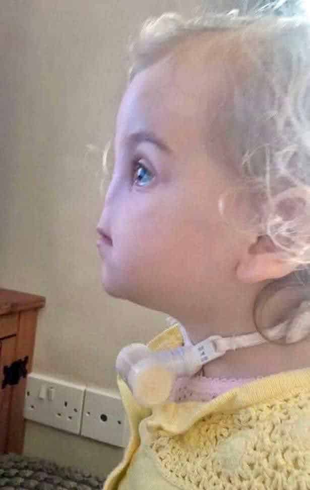 Viral Strange - Girl Born Without Nose Nicknamed “Voldemort” Gives ...