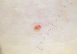 Viral Strange - Cherry Angiomas, the Tiny Red Spots on Your Body