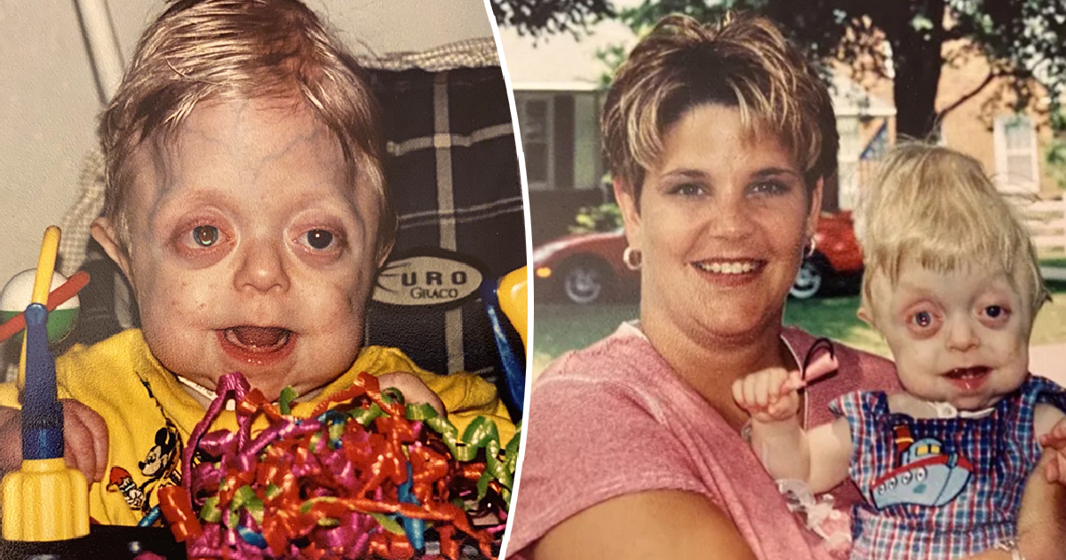 Braden West, Expected NOT to Live Past 18 Months, Actually Got to ...