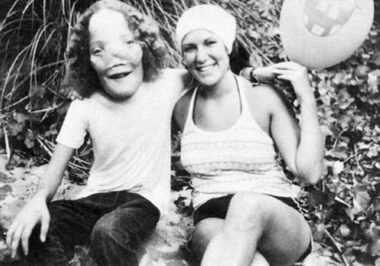 Rocky Dennis: The Inspiring True Story Behind the Film 'Mask'